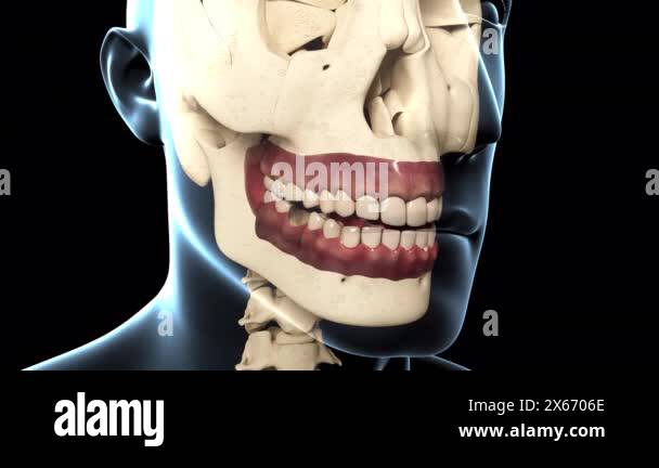 This 3d animation shows an overview of a dental caries Stock Video ...