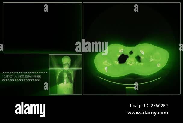 Image Analysis of Medical Examination. Motion CT scan of emphysema in ...