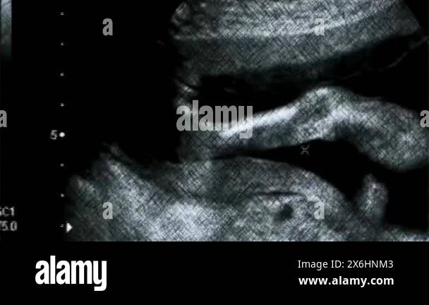 Collage of medical images of ultrasound during scan showing of pregnant ...