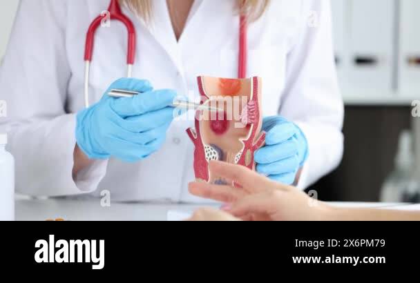 Doctor holds model of unhealthy lower rectum with inflamed vascular ...