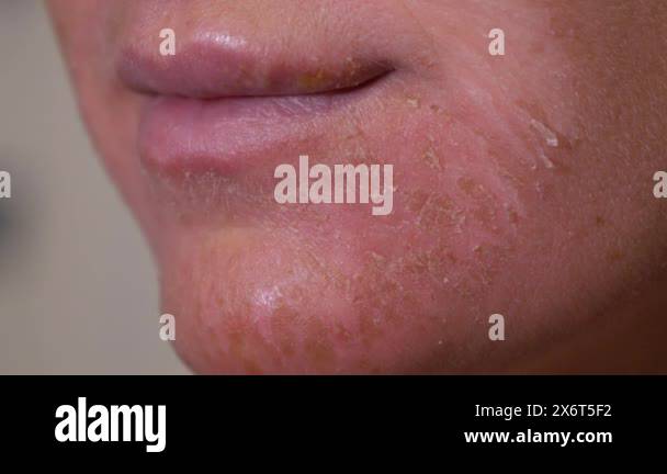 Inflammation of the epidermis Stock Videos & Footage - HD and 4K Video ...