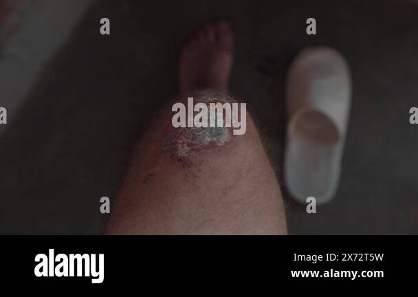 Infected wound scar on Stock Videos & Footage - HD and 4K Video Clips ...