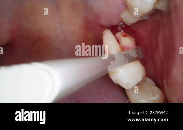 Pulled tooth blood Stock Videos & Footage - HD and 4K Video Clips - Alamy