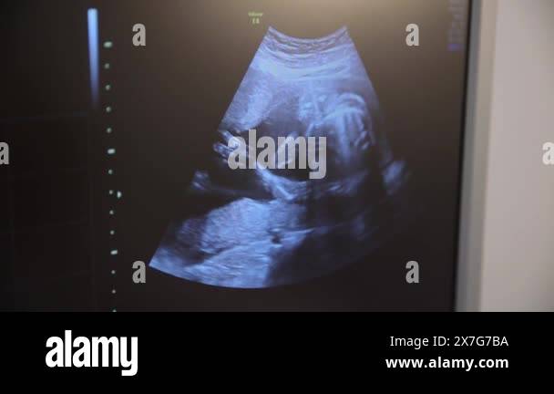 Video of ultrasound of the fetus under the diagnosis of a pregnant ...