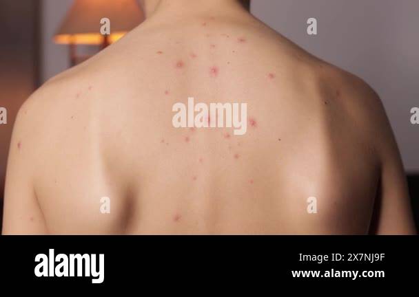 Rash on back Stock Videos & Footage - HD and 4K Video Clips - Alamy
