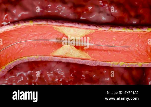 Blocked Artery, Collapsed balloon angioplasty procedure with Coronary ...
