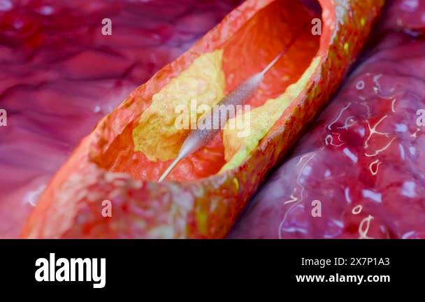 Blocked Artery, Collapsed balloon angioplasty procedure with Coronary stent in vein, blood flow ...