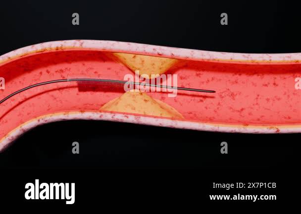 Blocked Artery, Collapsed balloon angioplasty procedure with Coronary ...