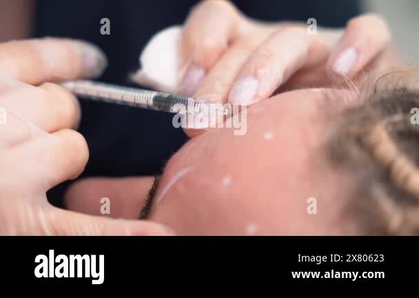 Beautician doctor makes botox injection in the forehead of young ...