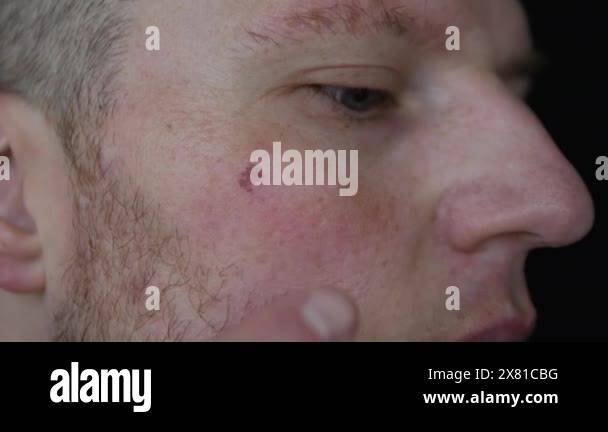 A wound near a man's eyes, a man examines a scar on his face. Damaged ...