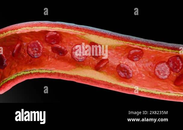 Cholesterrol or Atherosclerotic Plaque in blood vessels, Blocked vessel ...