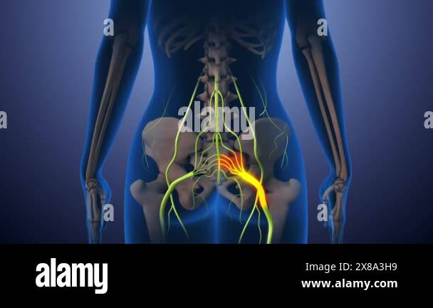 Sciatica pain anatomy Stock Videos & Footage - HD and 4K Video Clips ...