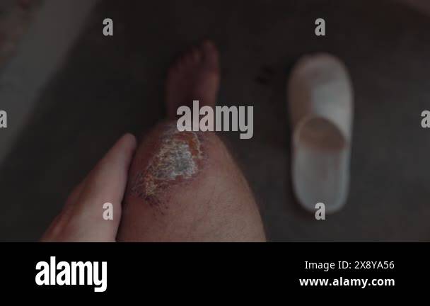Close-up of a severe wound on a male persons knee, showing detailed ...