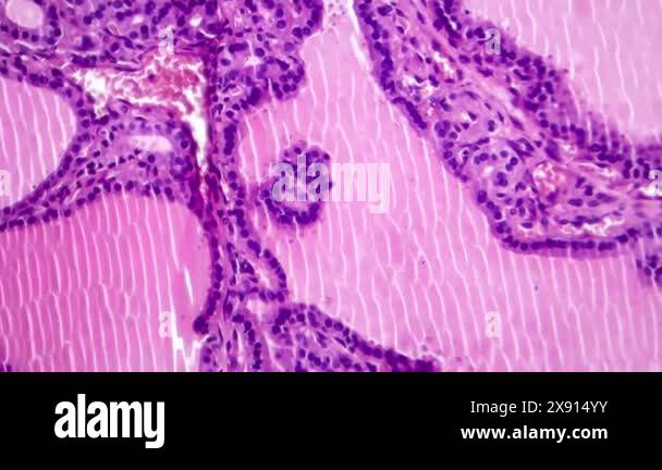 Light microscopy of the thyroid tissue of a patient with a toxic goitre ...