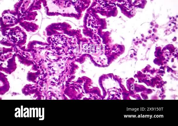 Light microscopy of the lung tissue of a patient with lung ...