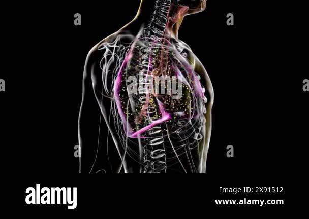Rotating animation showing miliary tuberculosis, a disseminated (spread ...