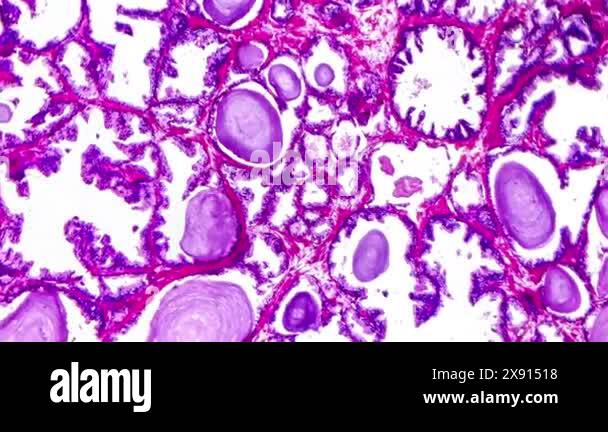 Light microscopy of tissue of a patient with benign prostatic ...