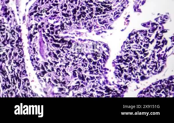 Light microscopy of a smoker's lung tissue. Smoking over time has ...