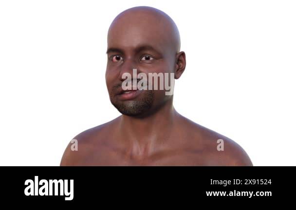 Animation of a man with facial palsy, a form of paralysis causing ...
