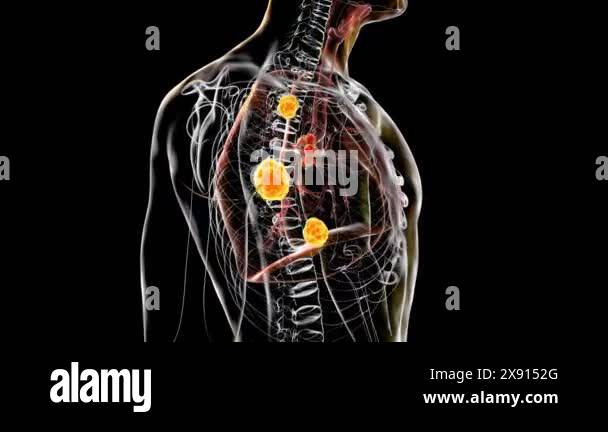 Pulmonary blastomycosis with lung lesions and enlarged bronchial lymph ...