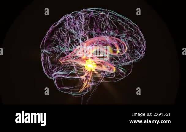 Animation depicting enlarged lateral and third ventricles of the brain ...