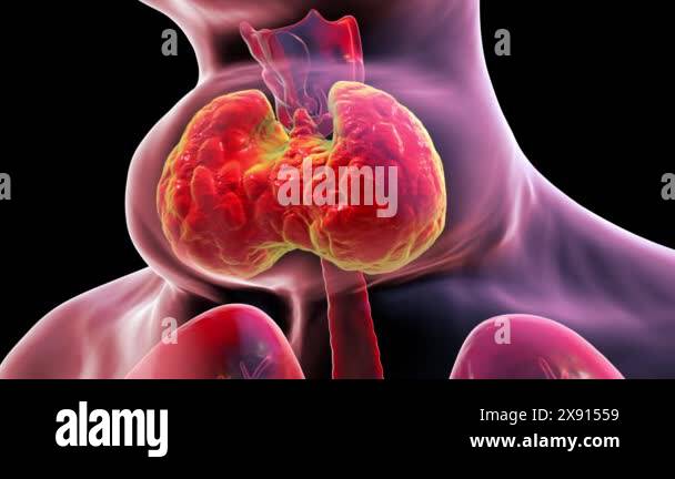 Enlarged thyroid Stock Videos & Footage - HD and 4K Video Clips - Alamy