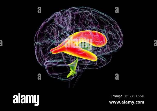 Animation showing enlarged lateral ventricles of the brain ...