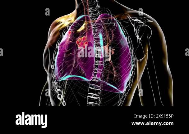 Animation showing primary lung tuberculosis with visible Ghon complex ...