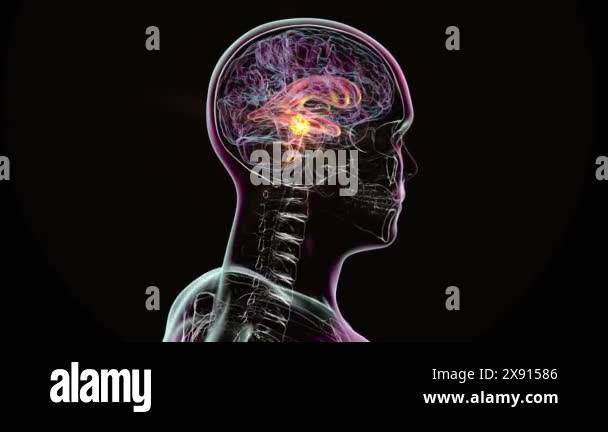 Animation depicting enlarged lateral and third ventricles of the brain ...