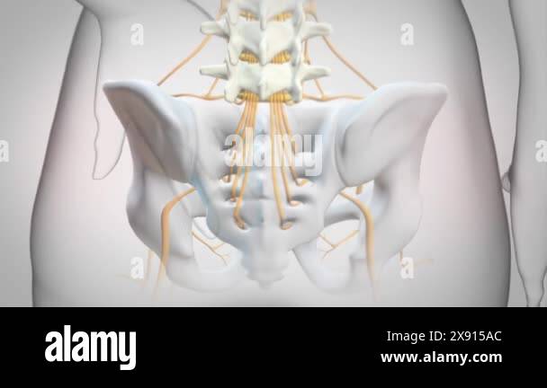 Inflammation of sacroiliac joints, also known as sacroiliitis ...