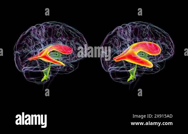 Animation showing enlarged lateral ventricles (hydrocephalus, right ...