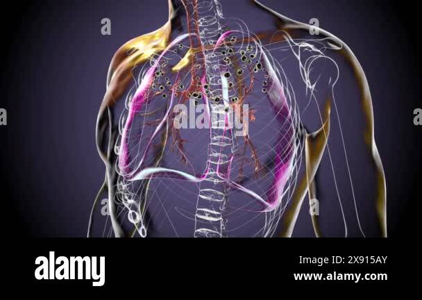 Animation depicting lungs affected by silicosis, showing dark silicotic ...