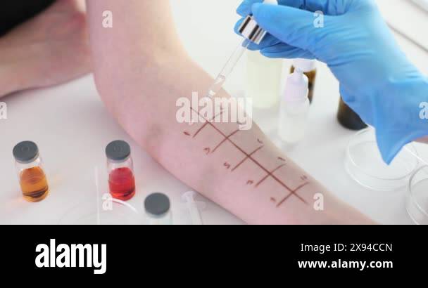 Skin prick test for allergies on the arm in clinic. Principles of ...