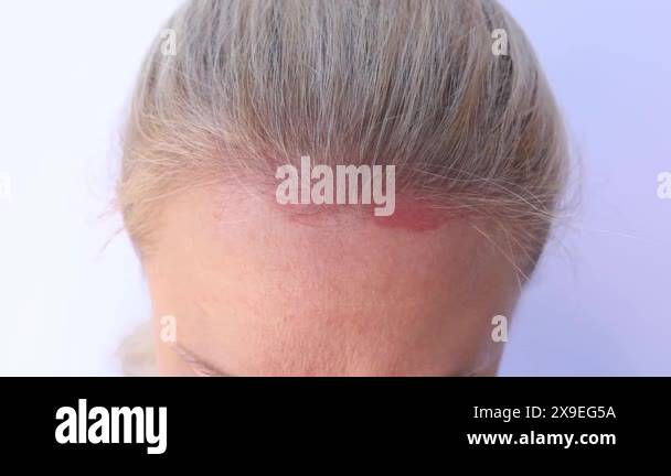 Dermatitis solar Stock Videos & Footage - HD and 4K Video Clips - Alamy