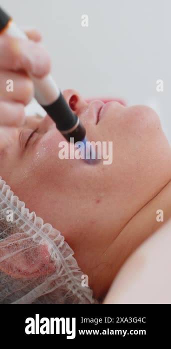 Peeling, woman health care, skin regeneration, dermapen microneedling ...