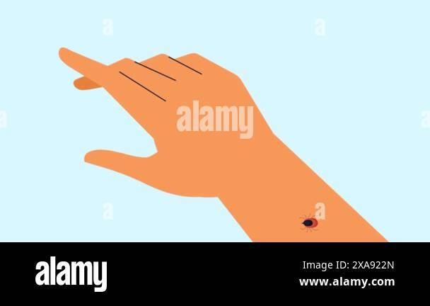 Tick insect bite Stock Videos & Footage - HD and 4K Video Clips - Alamy