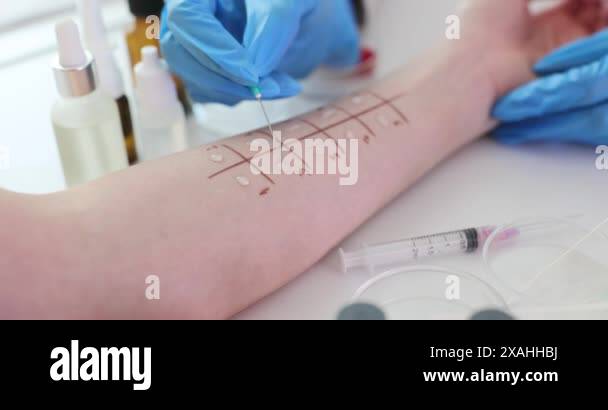 Allergy skin tests and prick test on patient skin in clinic. Doctor ...