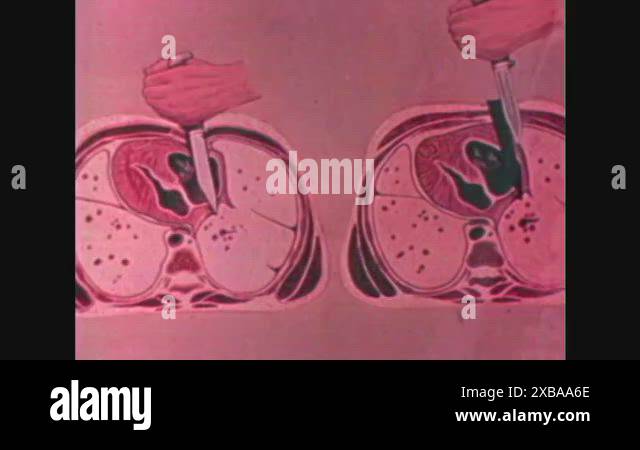 Stab wounds are explained on dead bodies at the morgue in the 1960s ...