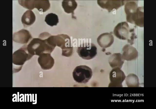 White blood cells are looked at under a microscope and bone marrow is ...