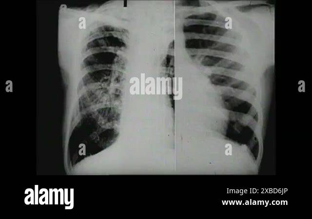 Dr. Mayer teaches us how to diagnose tuberculosis with x-rays during ...