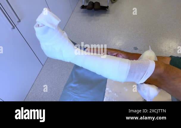 Broken leg hospital Stock Videos & Footage - HD and 4K Video Clips - Alamy