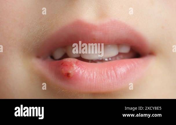 Wound on lip Stock Videos & Footage - HD and 4K Video Clips - Alamy