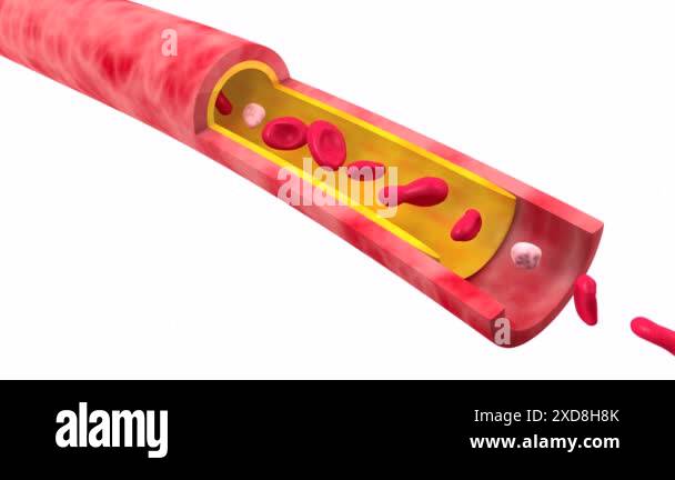 Anatomical 3D animation of the artery with the movement of obstruction ...