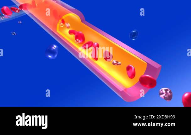 Anatomical 3D animation of an artery with obstruction due to fat stuck ...