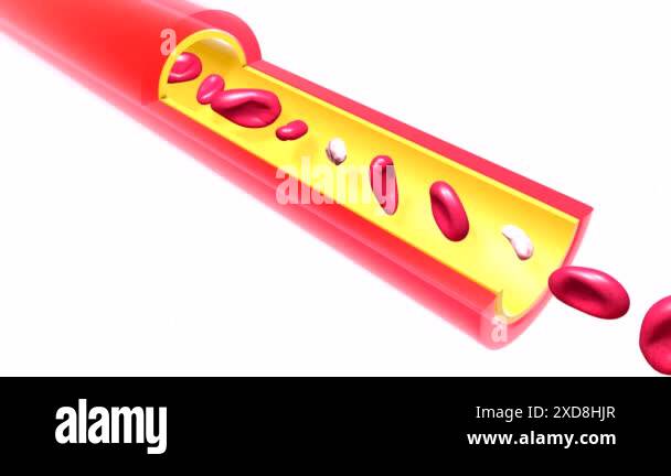 Anatomical 3D animation of an artery that is becoming blocked by ...