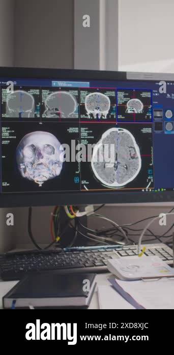 Mri brain scan on skull x ray Stock Videos & Footage - HD and 4K Video ...