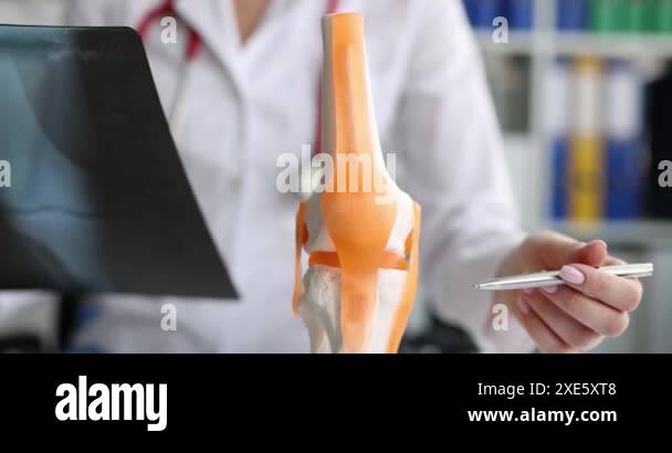Rheumatoid arthritis x ray knee Stock Videos & Footage - HD and 4K ...