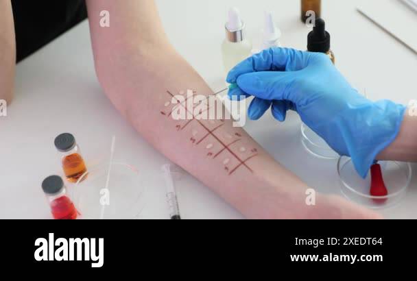 Allergy skin test needle Stock Videos & Footage - HD and 4K Video Clips ...