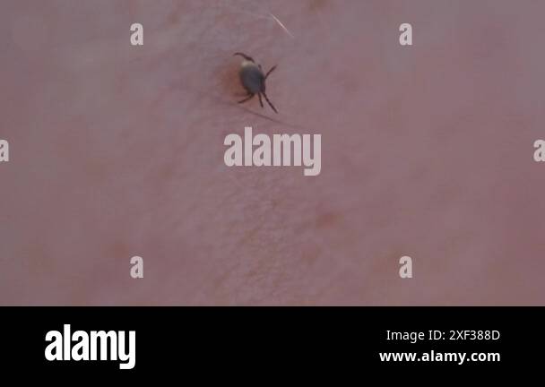 A tick on the skin that transmits dangerous diseases such as tick-borne ...
