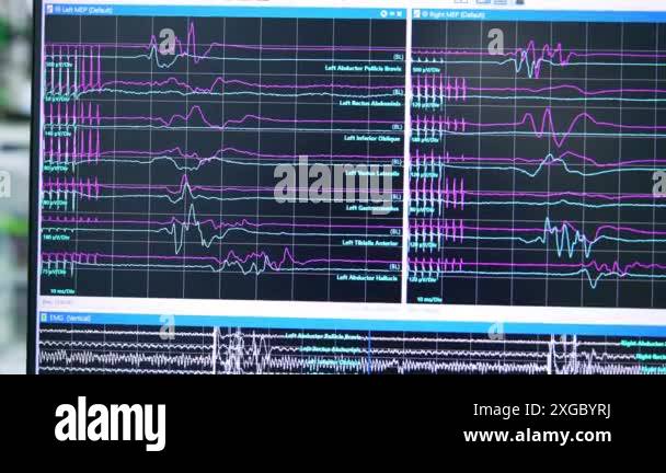 Curved lines on the screen of neuromonitoring equipment. Close up ...
